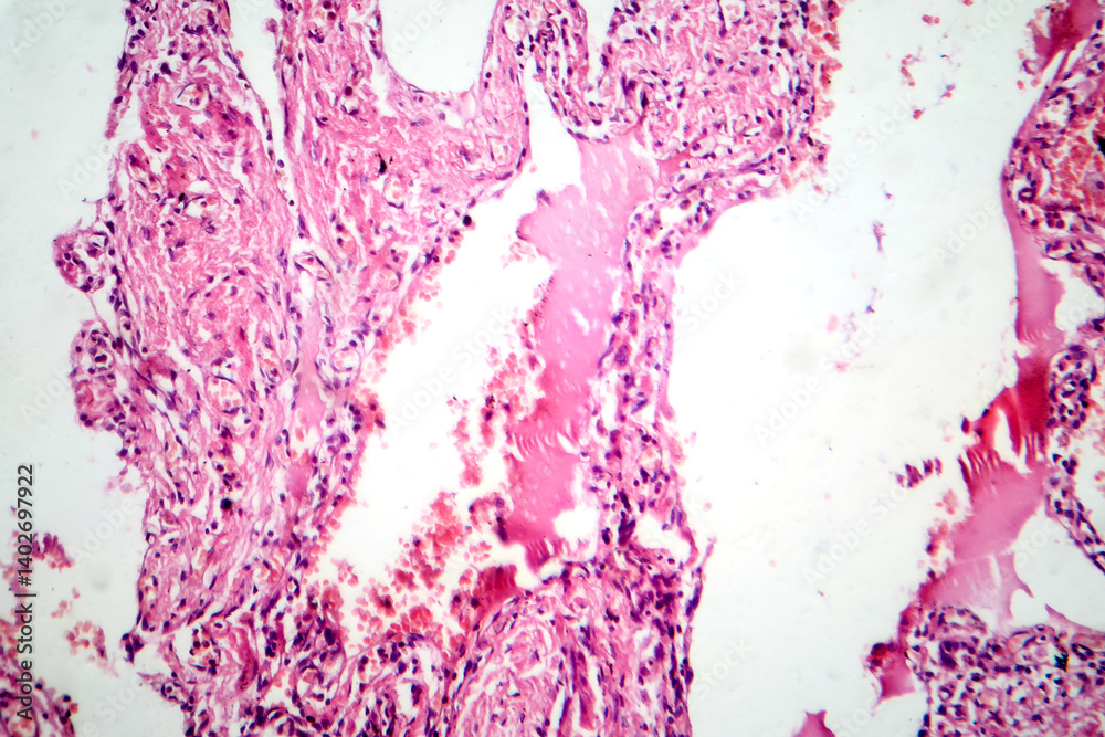 Póster Red hepatization stage of lobar pneumonia, photomicrograph ...