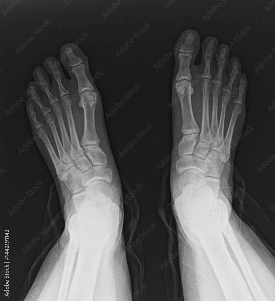 Poster Medical x-ray revealing normal foot and ankle bone alignment, demonstrating skel – Wall ...