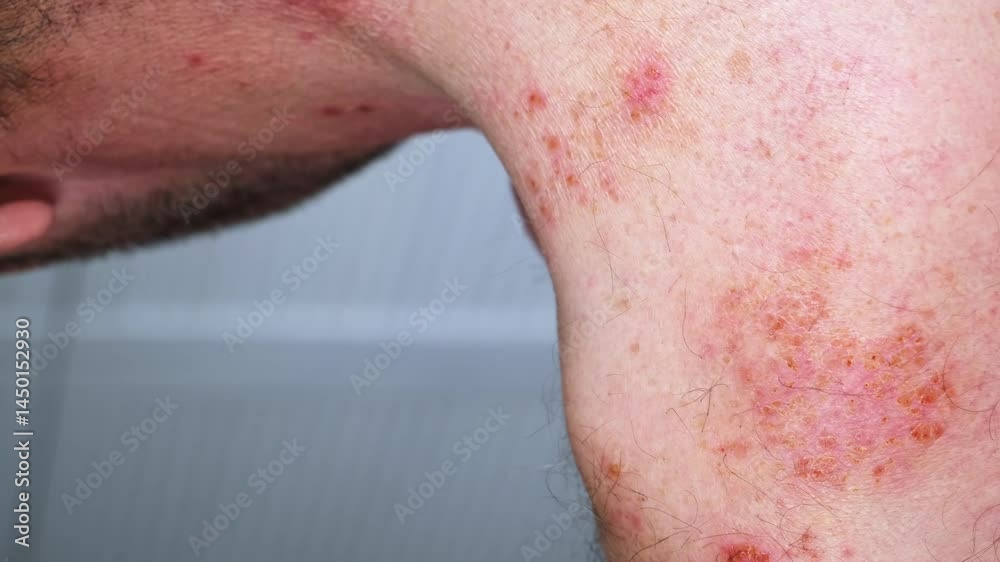 Skin lesion symptom in Shingles or Herpes zoster in person. Viral ...