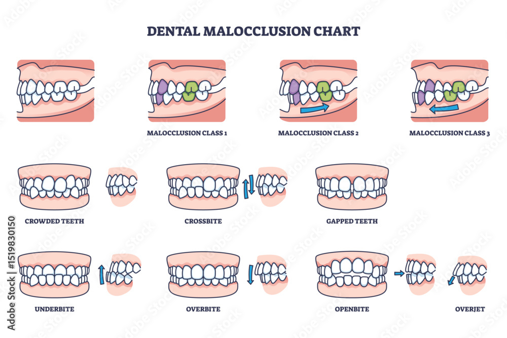Póster Dental malocclusion chart shows types of teeth misalignment, including overbite ...