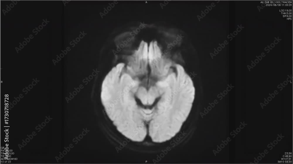 Magnetic resonance images of the brain, MRI of the brain, of a patient ...
