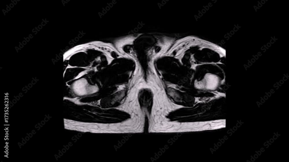 MRI Pelvic Scan Showing Hip Muscles, Pelvis Nerve Structures in Cross ...
