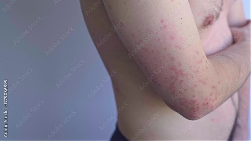 Man with small red rash after viral infection swollen lymph nodes and ...