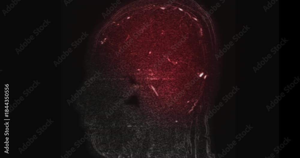 MR cerebral venography (MRV) or MRV Brain for diagnostic Cerebral ...